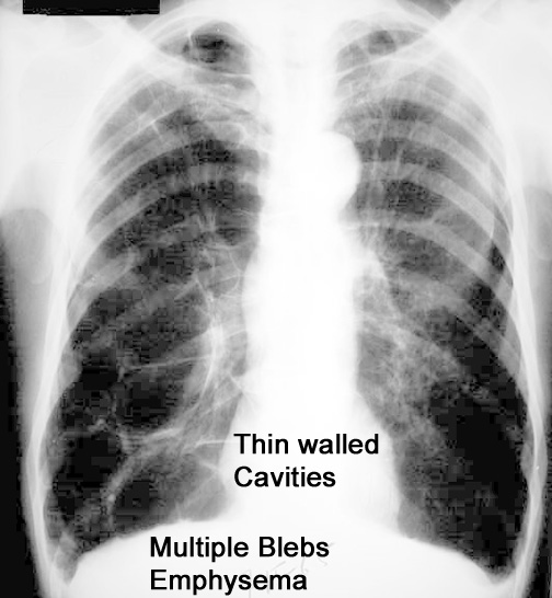 Cavity in Chest x-ray / Radiology