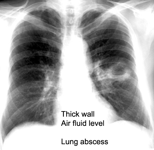 Lung Abscess Radiology