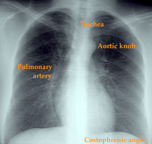Chest x-ray as a diagnostic tool