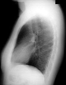 Chest x-ray as a diagnostic tool