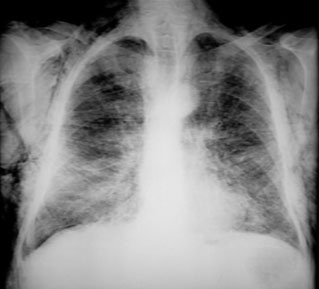 Note air in the softtissues.