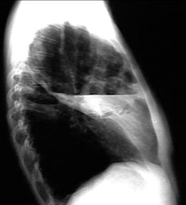 Lung Abscess