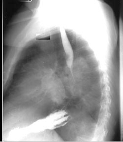 Tracheo-Esophageal Stripe