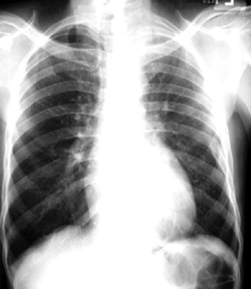 cxr list 1