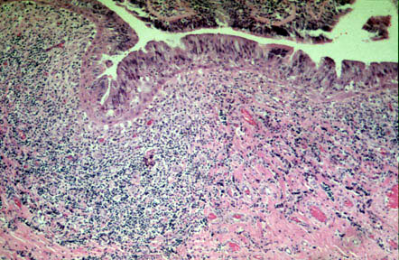 Saccular bronchiectasis follows destructive inflammation of the ...