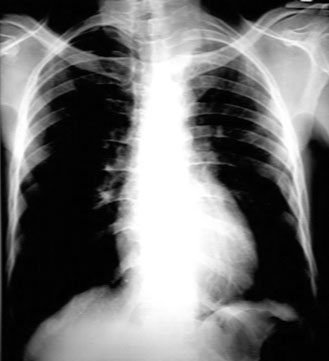 Note the apicalmass.