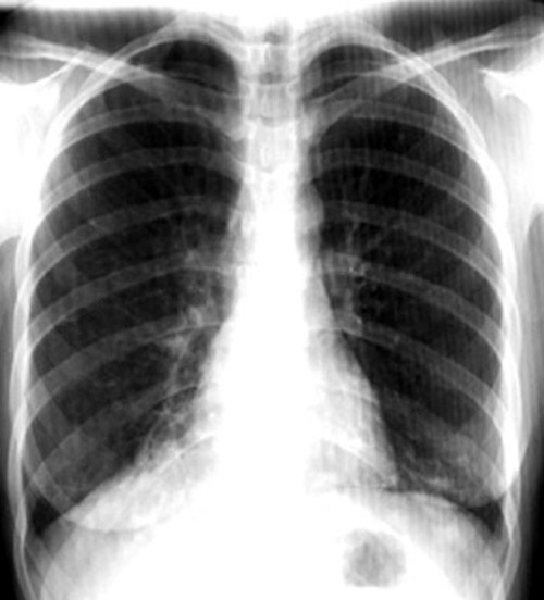 cxr list 1