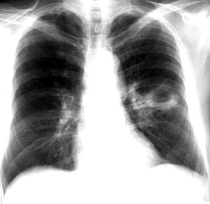 Lung Abscess