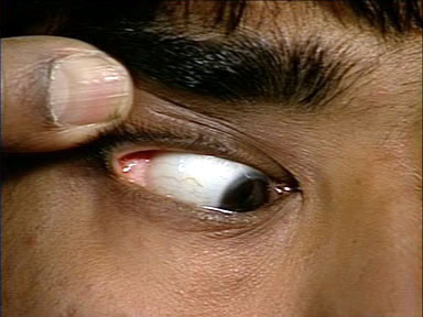 External Examination of Eyes