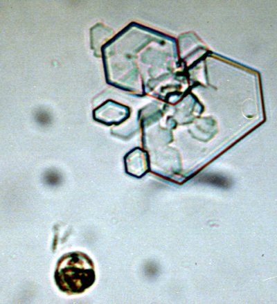 Cystine Crystals In Urine