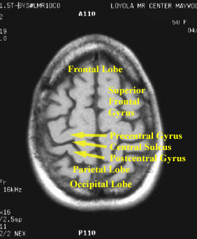 Postcentral Gyrus Mri