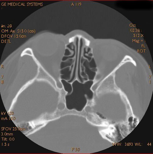 ENT Radiological Anatomy