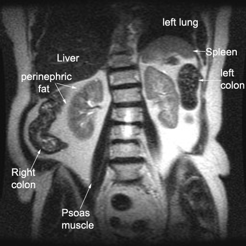 identify perinephric fat in this mri click the image