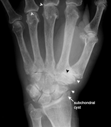 Osteoarthritis Hand