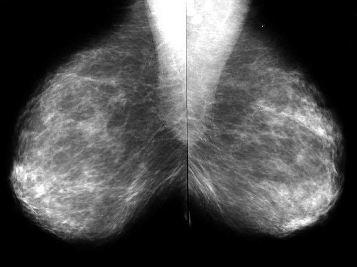Mammogram Image Atlas