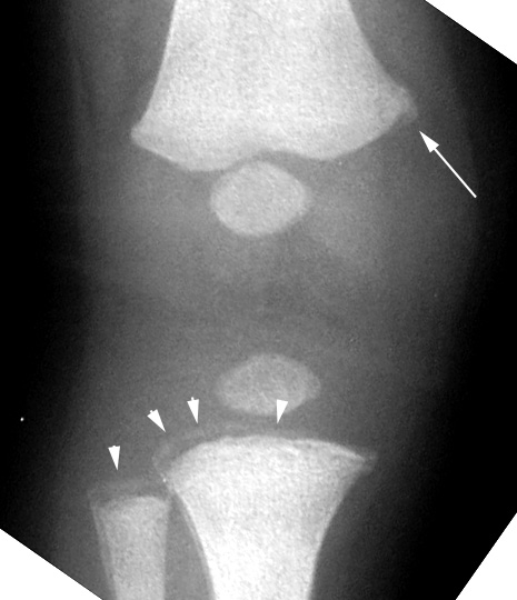 Tibia and fibula: arrowheads point to fracture that runs across ...