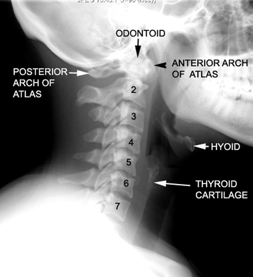 Identify the Odontoid and posterior arch of Atlas. Click the image for ...