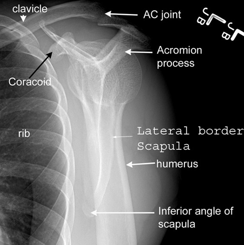 Labeled Scapula Bone