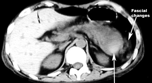 Acute Hemorrhagic pancreatitis