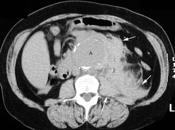 Ruptured Abdominal Aortic Aneurysm