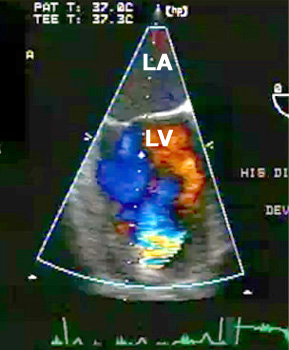 Echocardiogram