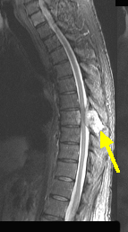 Spinal cord compression from metastatic disease.