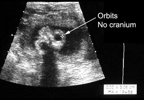Anencephaly