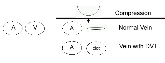 On the doppler ultrasound, decreased or absent spontaneous venous blood ...
