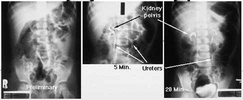 G/U Imaging: IVP-Normal